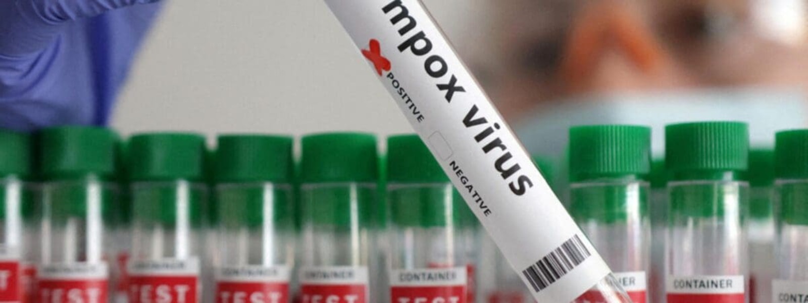 Mali confirms five Mpox cases and one death since November | APAnews ...